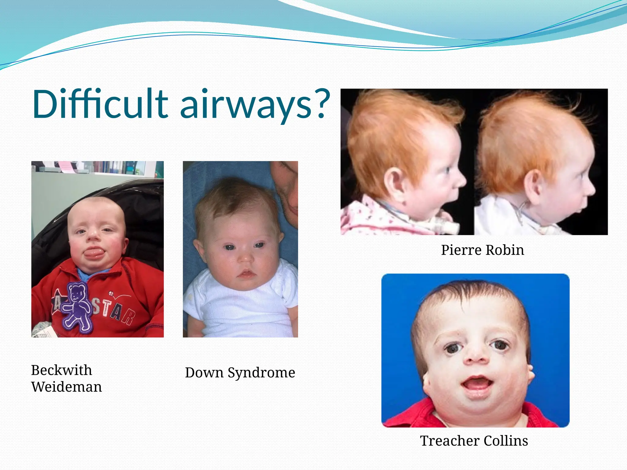 Pediatric Airway Management Explanation and challenges | PPTX