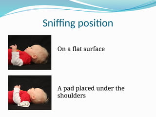 Pediatric Airway Management Explanation and challenges | PPTX