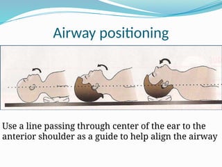 Pediatric Airway Management Explanation and challenges | PPTX