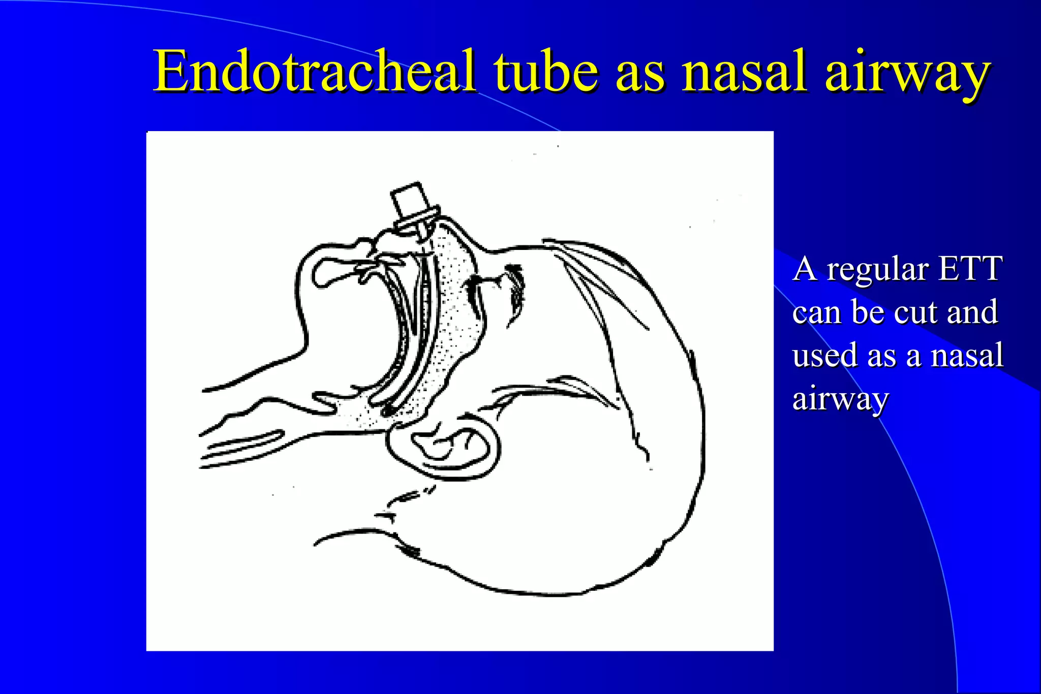 Pediatric airway management winkler | PPT