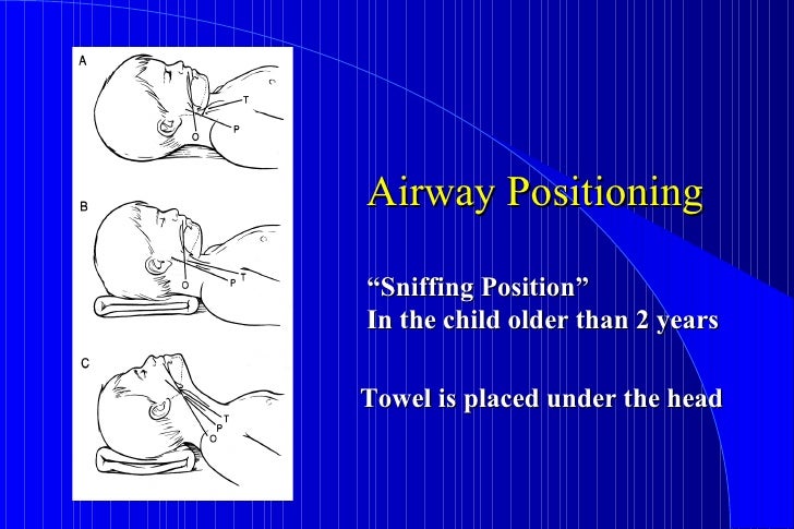 Pediatric airway management winkler