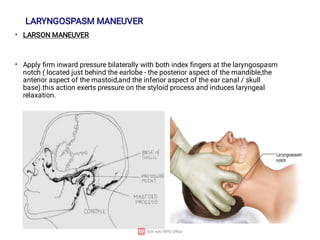 PEDIATRIC Anesthesia and airway management | PDF
