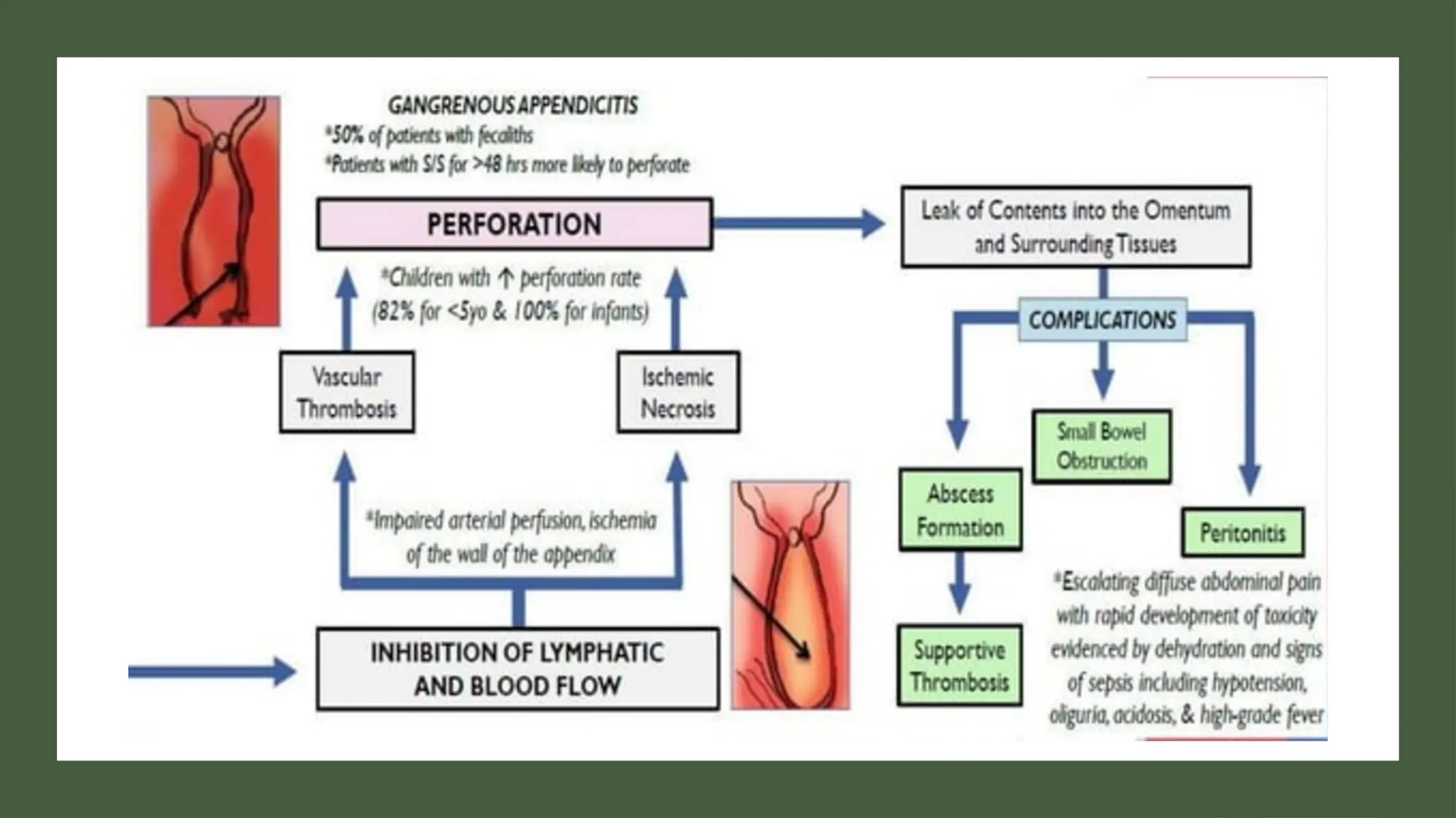 discussion on Pediatric Appendicitis case.pptx