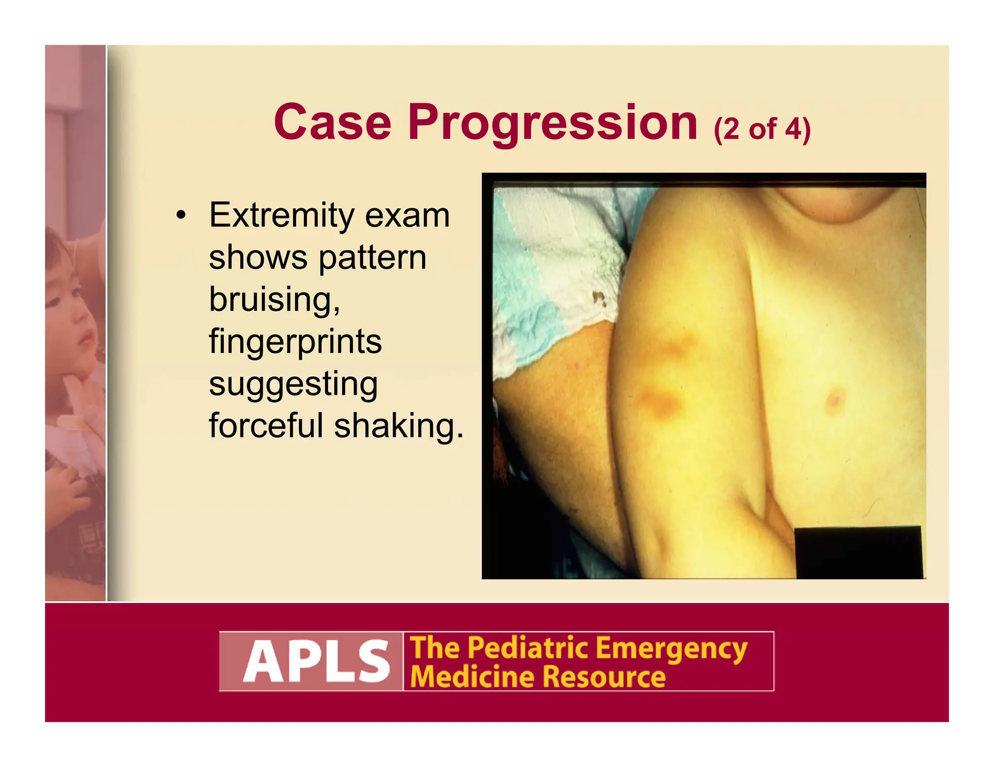 Pediatric Assessment Triangle in Children. pdf | PDF