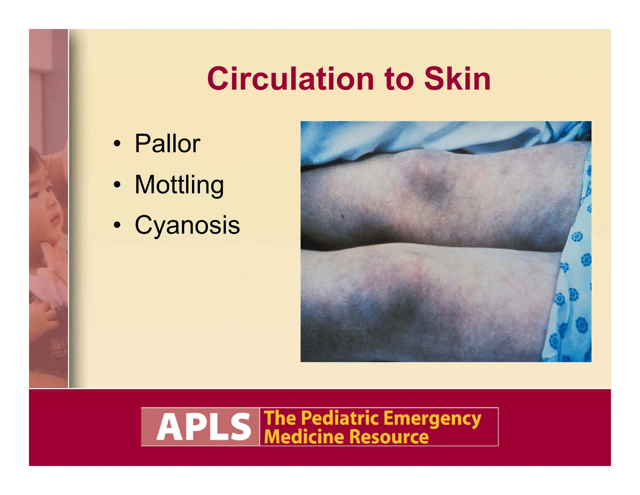 Pediatric Assessment Triangle in Children. pdf | PDF