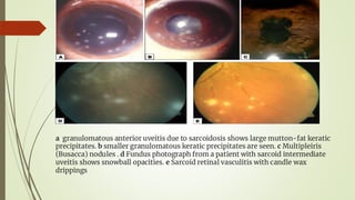 PEDIATRIC UVEITIS EXPLANATION ALONG WITH ANATOMY OF UVEA | PDF