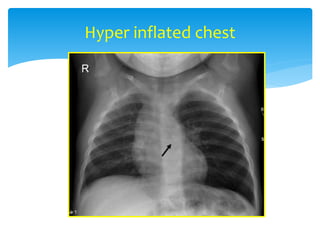 Pediatric asthma diagnosis | PPTX
