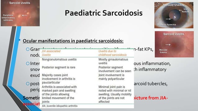 Pediatric autoimmune uveitis.pptx