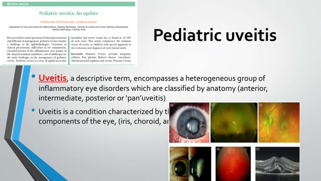 Pediatric autoimmune uveitis.pptx