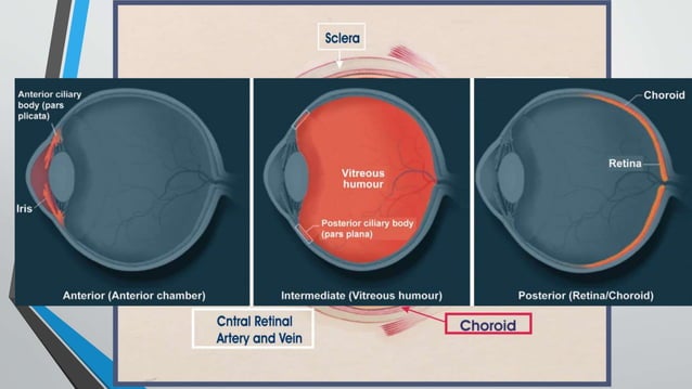 Pediatric autoimmune uveitis.pptx