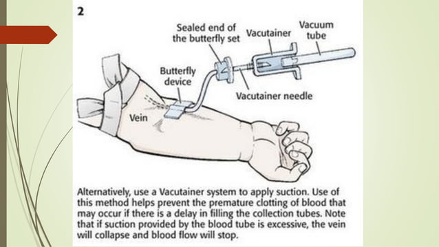 Pediatric blood sampling technique | PDF