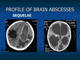 Pediatric brain abscesses profile | PPT