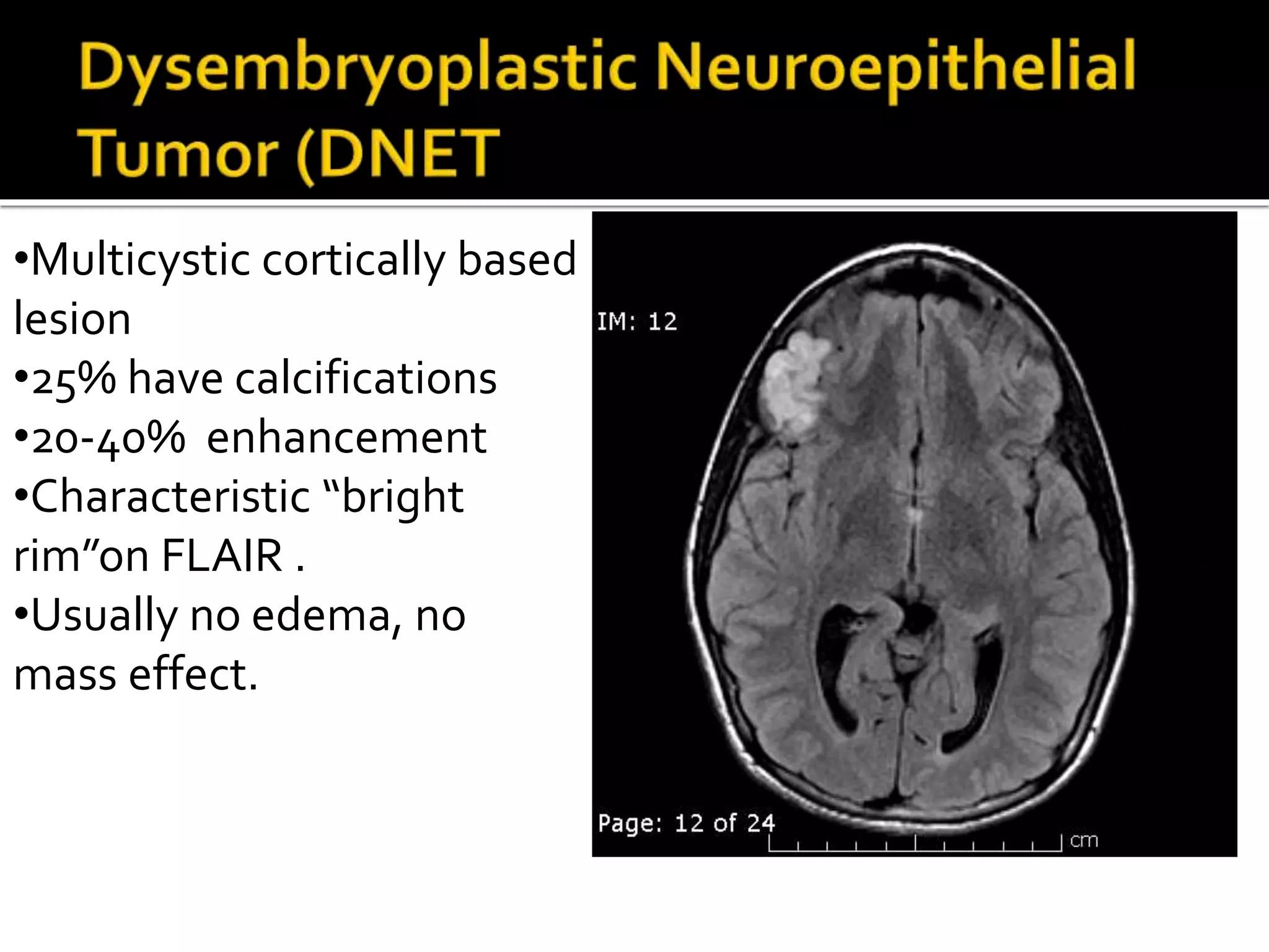 Pediatric brain tumors | PPTX