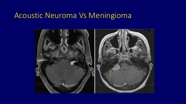 Pediatric brain tumors Dr. Muhammad Bin Zulfiqar