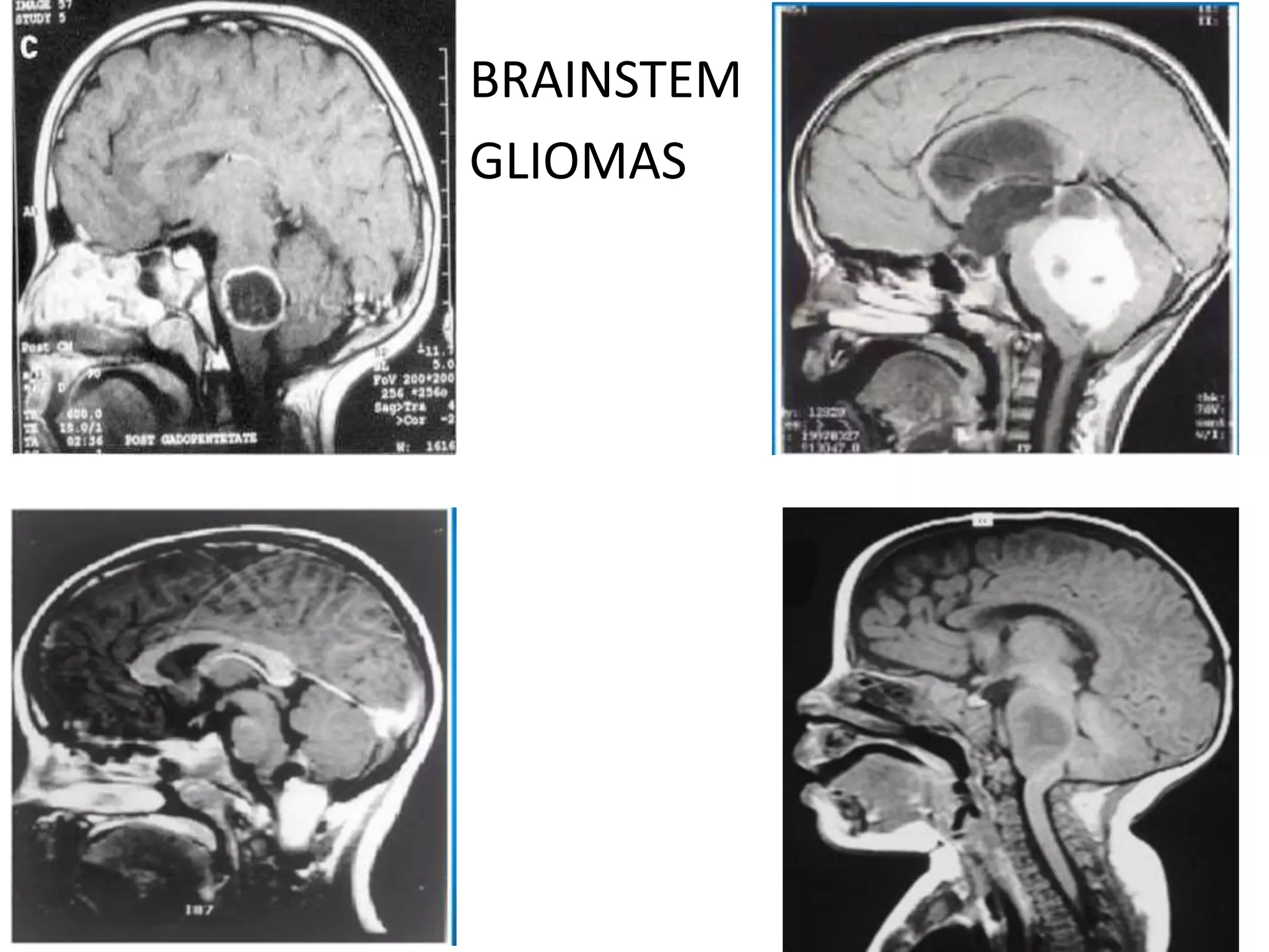Pediatric brain tumors | PPTX