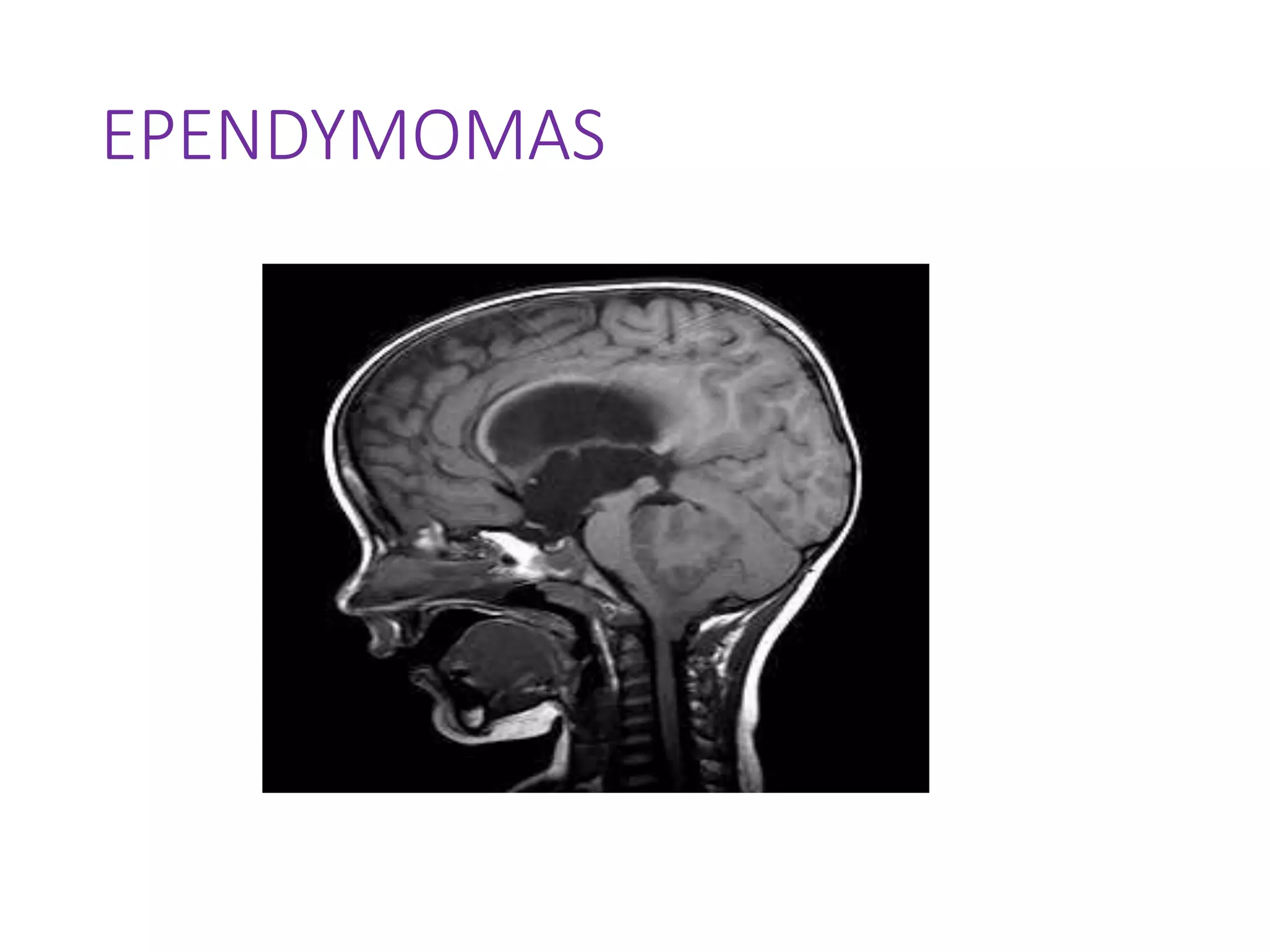 Pediatric brain tumors | PPTX