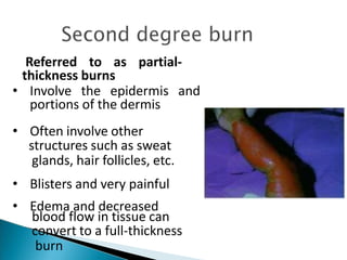 Pediatric burns | PPTX