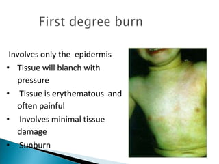 Pediatric burns | PPTX