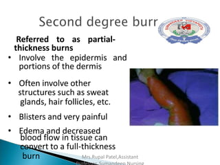 Pediatric burns | PPTX
