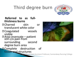 Pediatric burns | PPTX