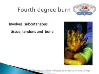 Pediatric burns | PPTX