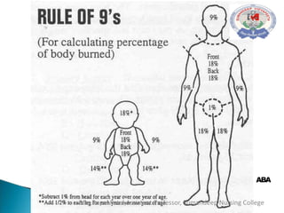 Pediatric burns | PPTX