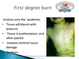 Pediatric burns | PPTX