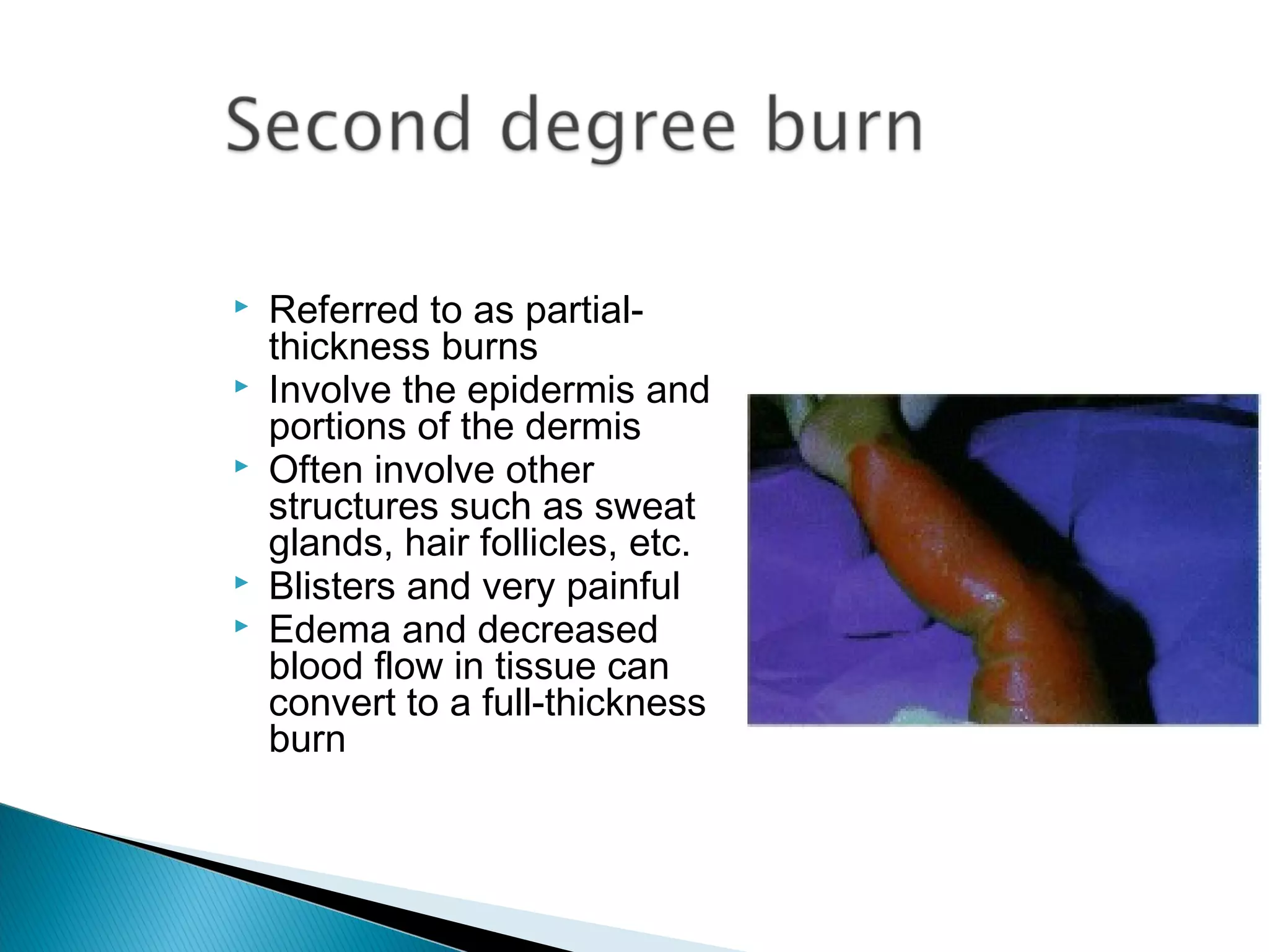 Pediatric burns | PPT