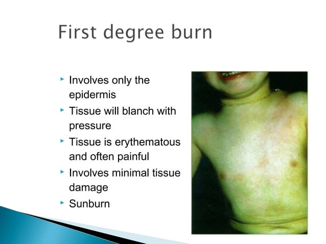 Pediatric burns | PPT | First Aid | Injuries