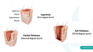 Comprehensive Guide to Pediatric Burns: Causes, Classification, and ...
