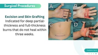 Comprehensive Guide to Pediatric Burns: Causes, Classification, and ...