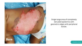 Comprehensive Guide to Pediatric Burns: Causes, Classification, and ...