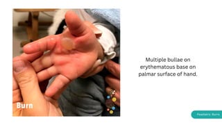 Comprehensive Guide to Pediatric Burns: Causes, Classification, and ...