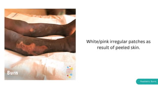 Comprehensive Guide to Pediatric Burns: Causes, Classification, and ...