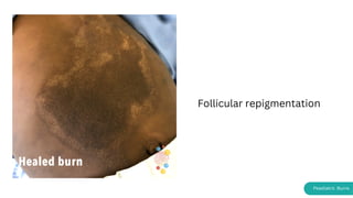 Comprehensive Guide to Pediatric Burns: Causes, Classification, and ...