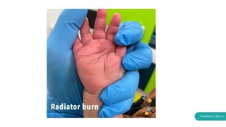 Comprehensive Guide to Pediatric Burns: Causes, Classification, and ...