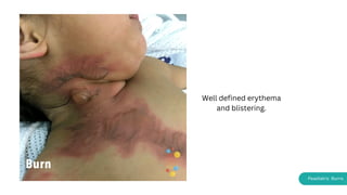 Comprehensive Guide to Pediatric Burns: Causes, Classification, and ...