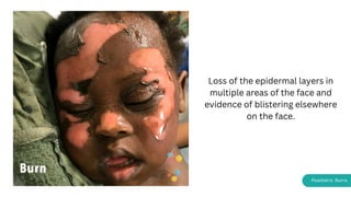 Comprehensive Guide to Pediatric Burns: Causes, Classification, and ...