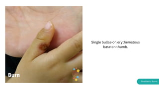 Comprehensive Guide to Pediatric Burns: Causes, Classification, and ...