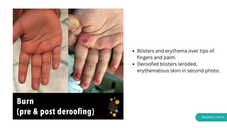 Comprehensive Guide to Pediatric Burns: Causes, Classification, and ...
