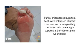 Comprehensive Guide to Pediatric Burns: Causes, Classification, and ...