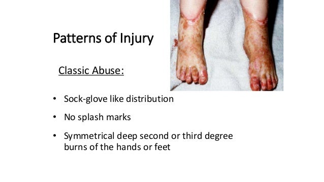 Pediatric burns seminar