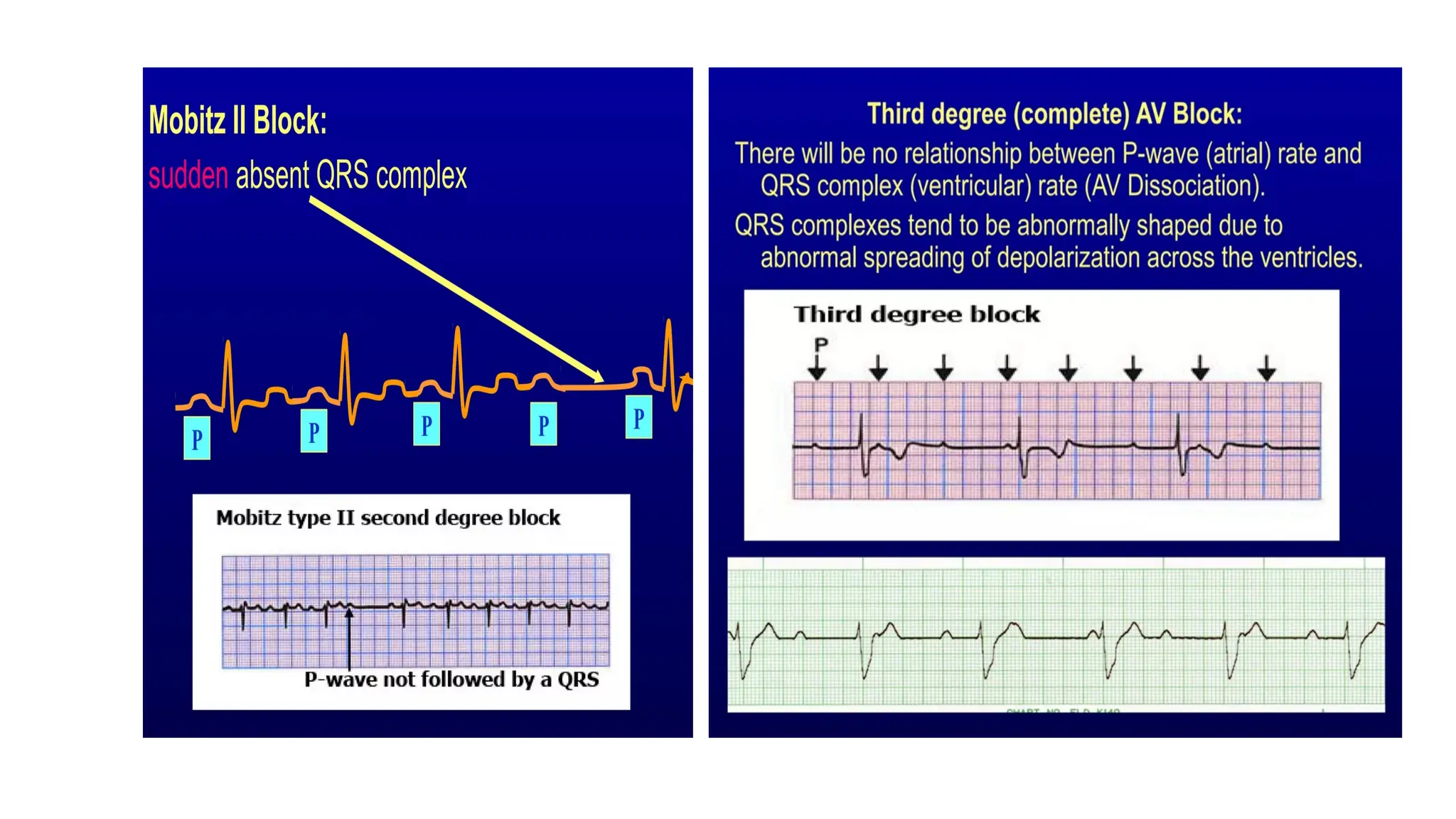 PEDIATRIC NURSING CARDIAC EMERGENCY AND ECG interpretation | PPT