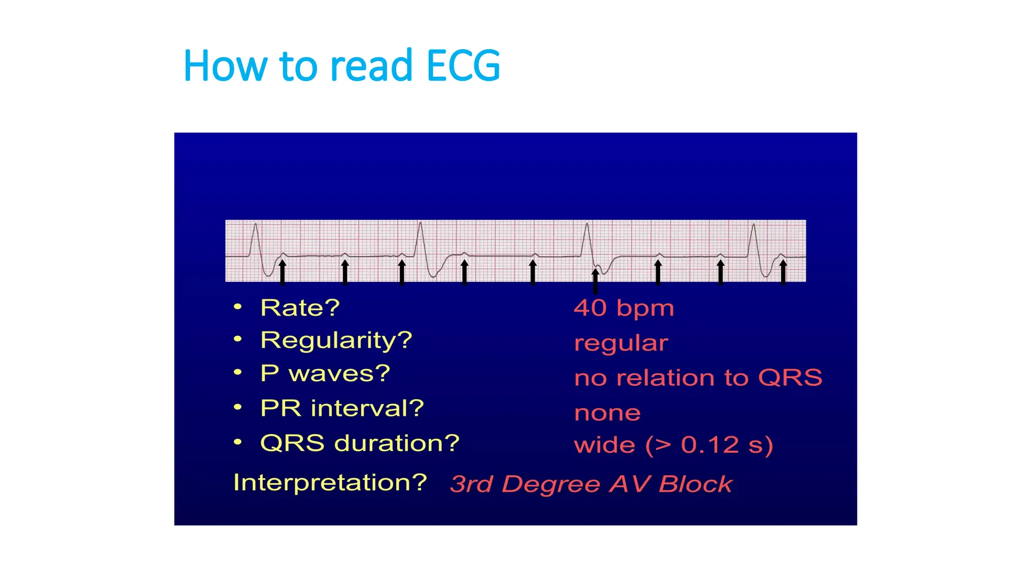 PEDIATRIC NURSING CARDIAC EMERGENCY AND ECG interpretation | PPTX