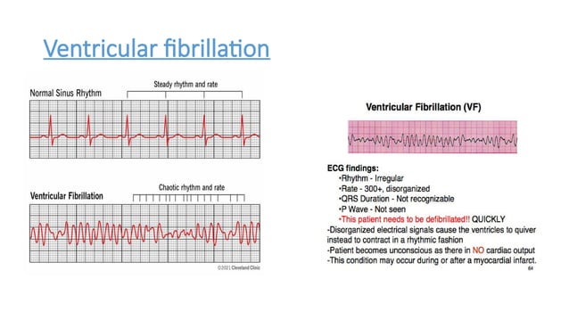 PEDIATRIC NURSING CARDIAC EMERGENCY AND ECG interpretation | PPT