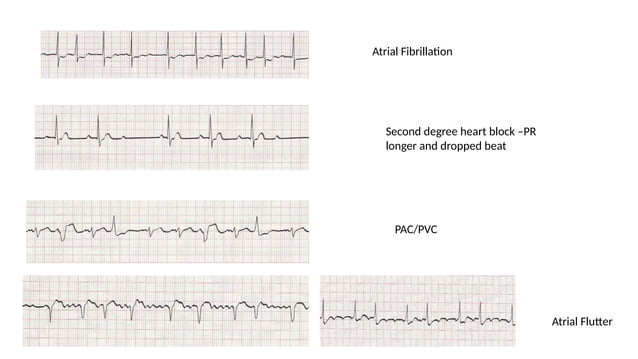 PEDIATRIC NURSING CARDIAC EMERGENCY AND ECG interpretation | PPT