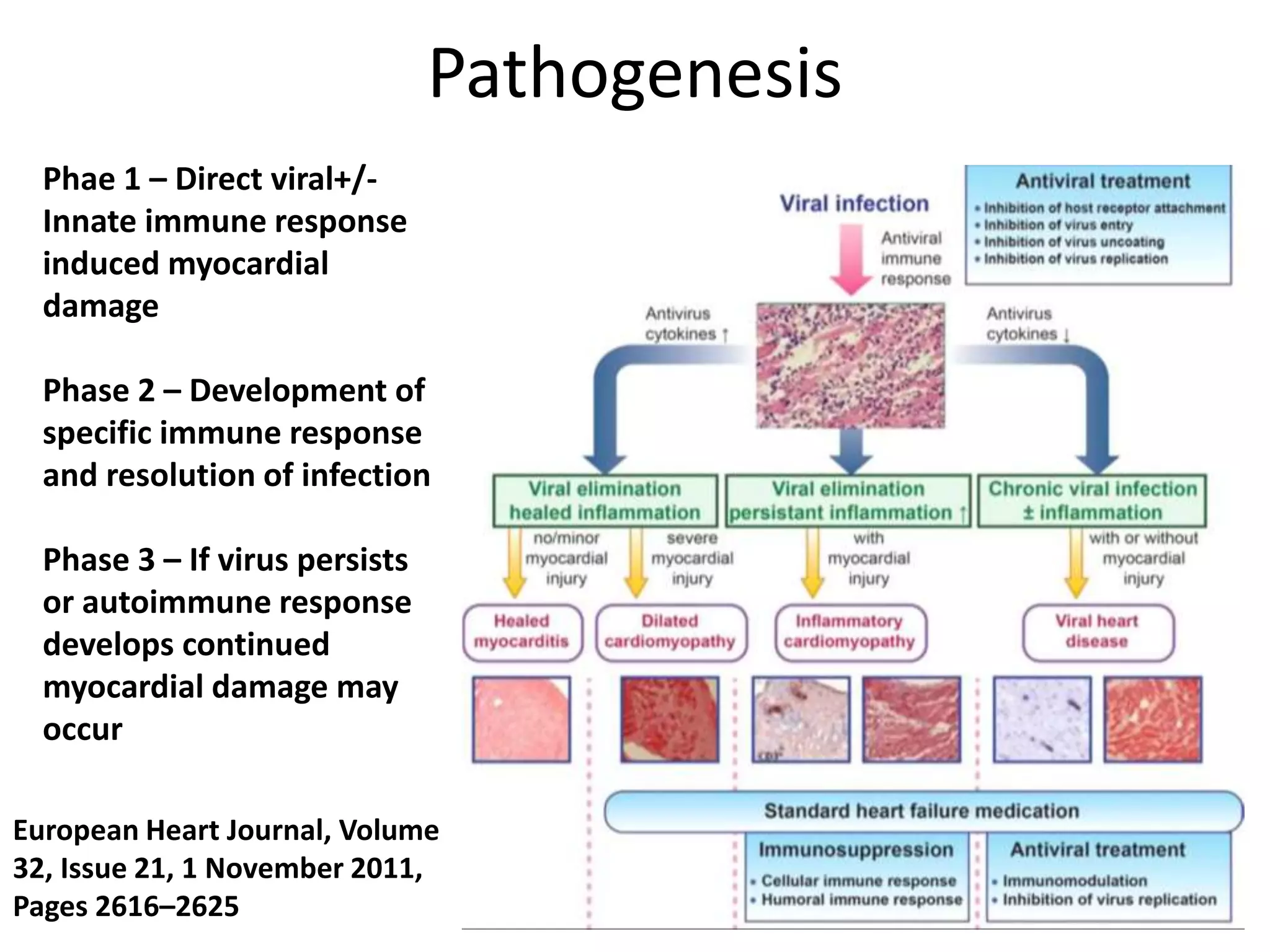 Pediatric cardiomyopathy | PPTX