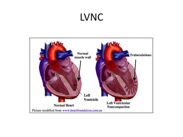 Pediatric cardiomyopathy | PPTX