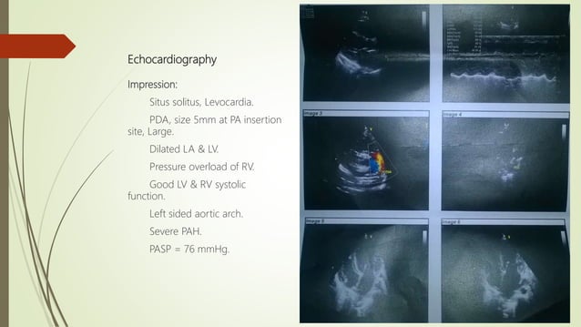 Pediatric case presentation (congenital heart disease- PDA) | PPTX