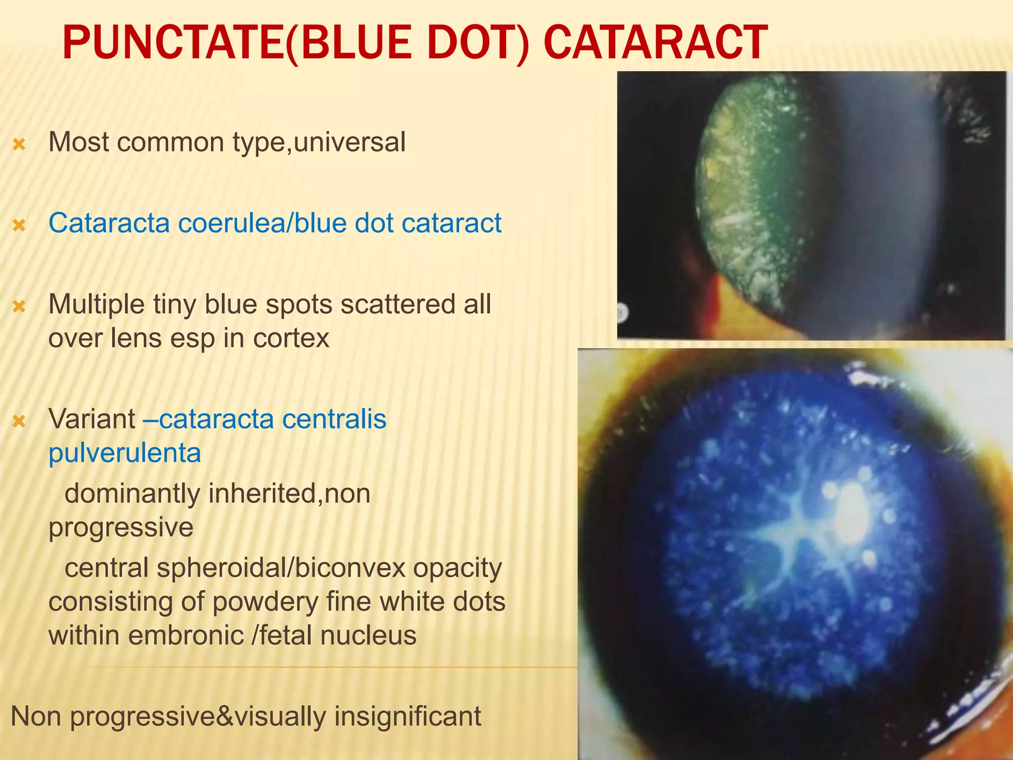 Pediatric cataract | PPTX